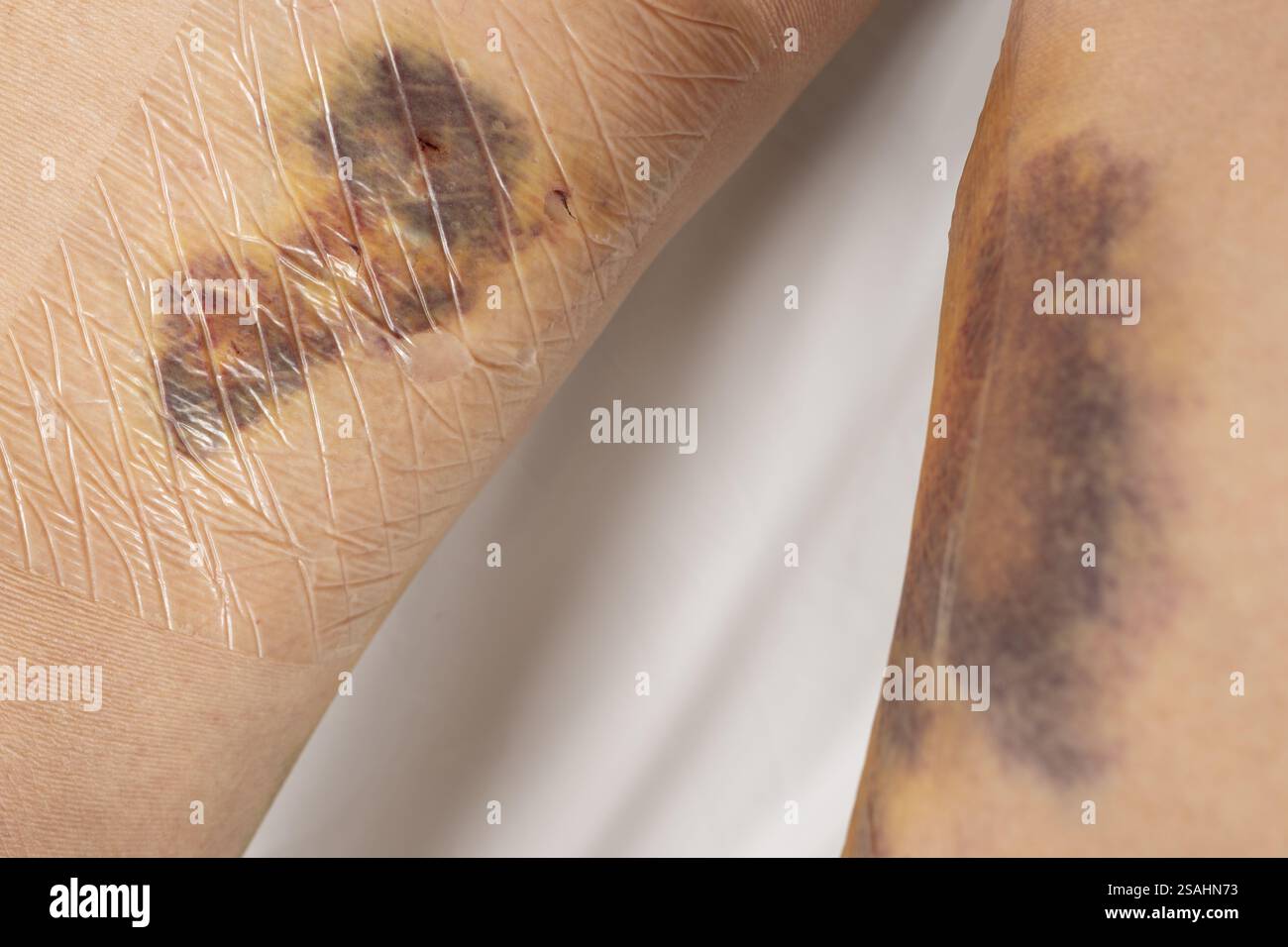 Scars on the lower leg of a woman after varicose vein. Hematomas from ...