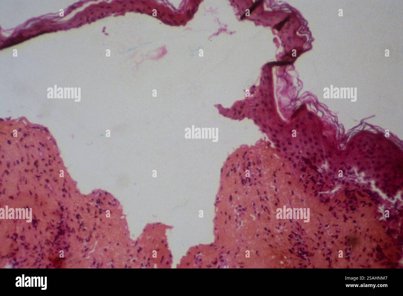 Toxidermy or drug eruption. Subepidermal blister. Histological section ...