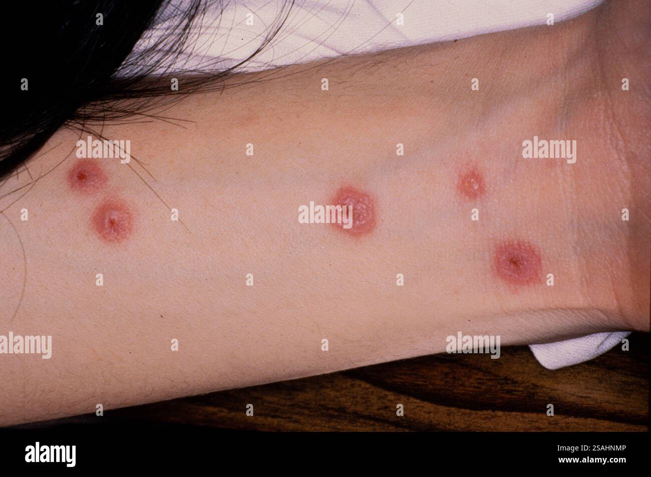 Stevens johnson syndrome hi-res stock photography and images - Alamy