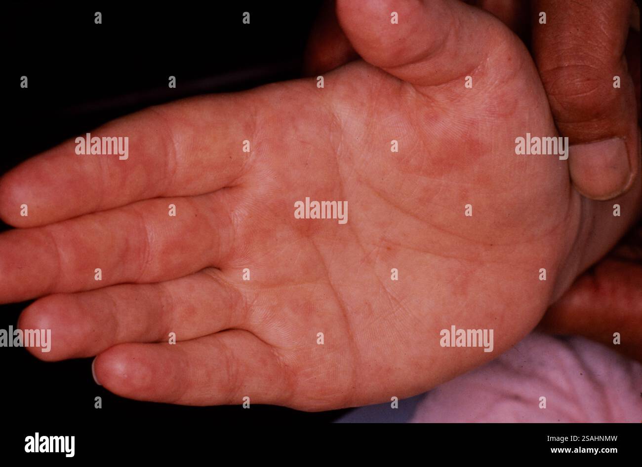 Stevens-Johnson syndrome inside the hand Stock Photo - Alamy