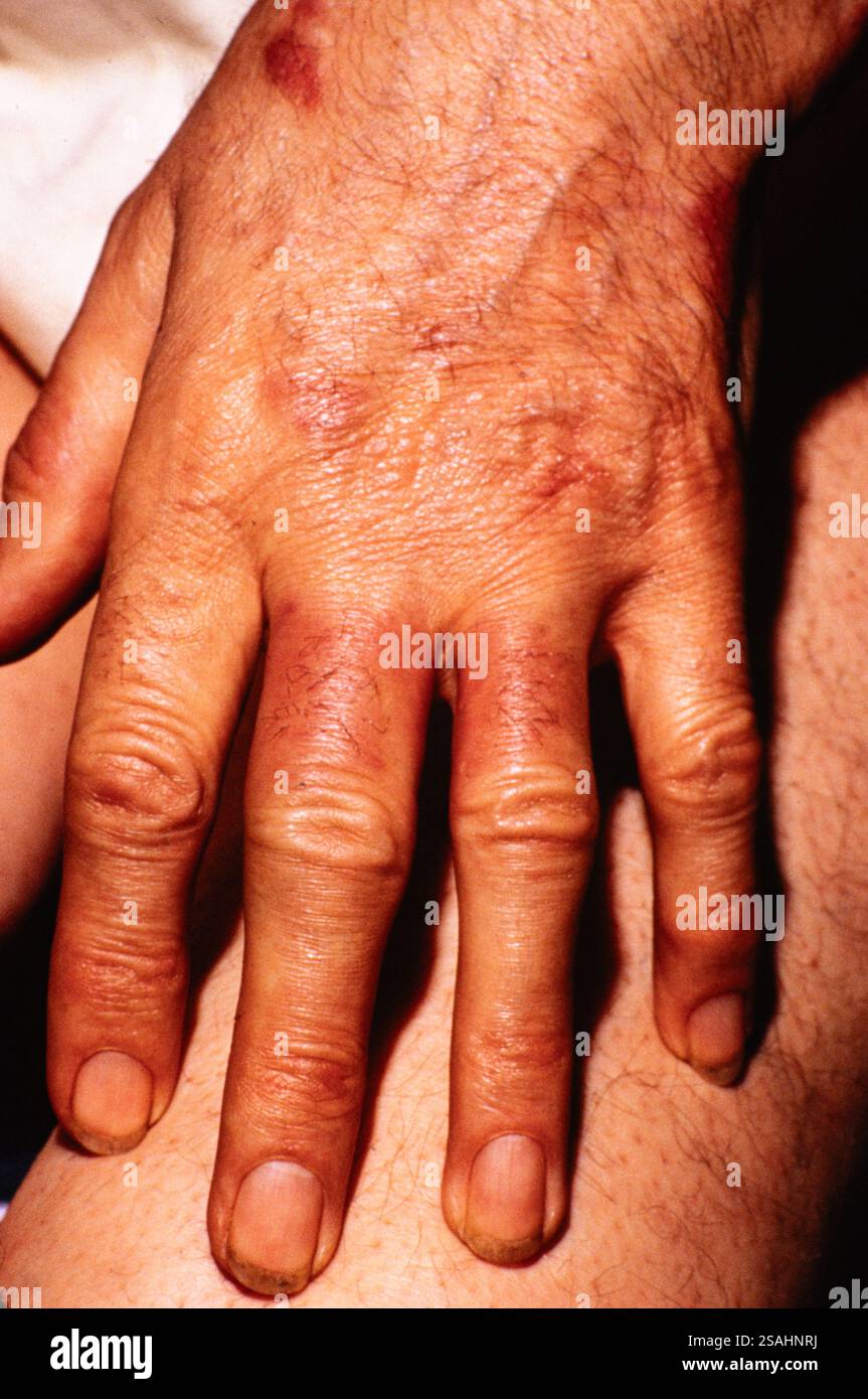 Kaposi's sarcoma in a hand Stock Photo - Alamy