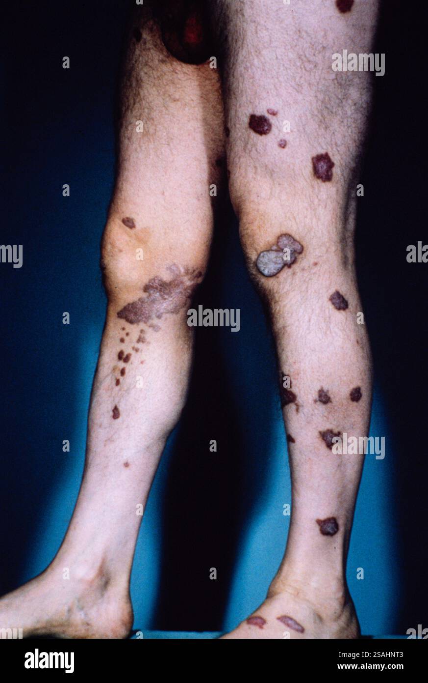 Sarcoma leg hi-res stock photography and images - Alamy