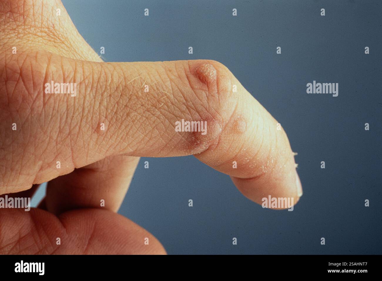 Wart on a man's left index finger Stock Photo - Alamy