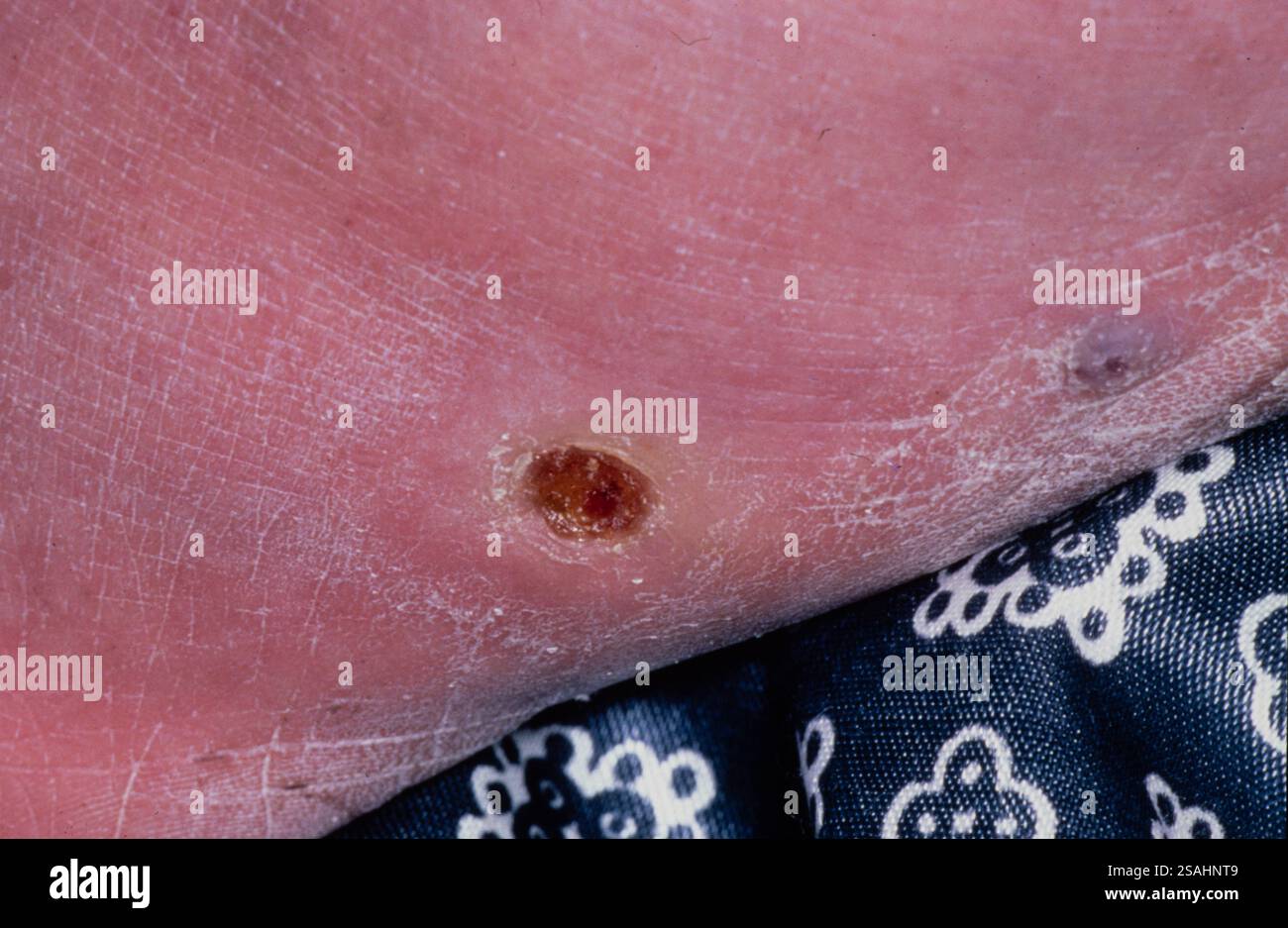 Kaposi's sarcoma hi-res stock photography and images - Alamy
