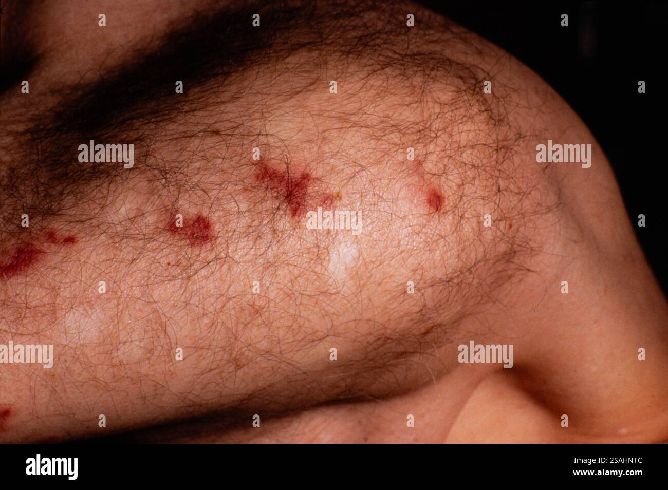 Kaposi's sarcoma on a man's arm Stock Photo - Alamy