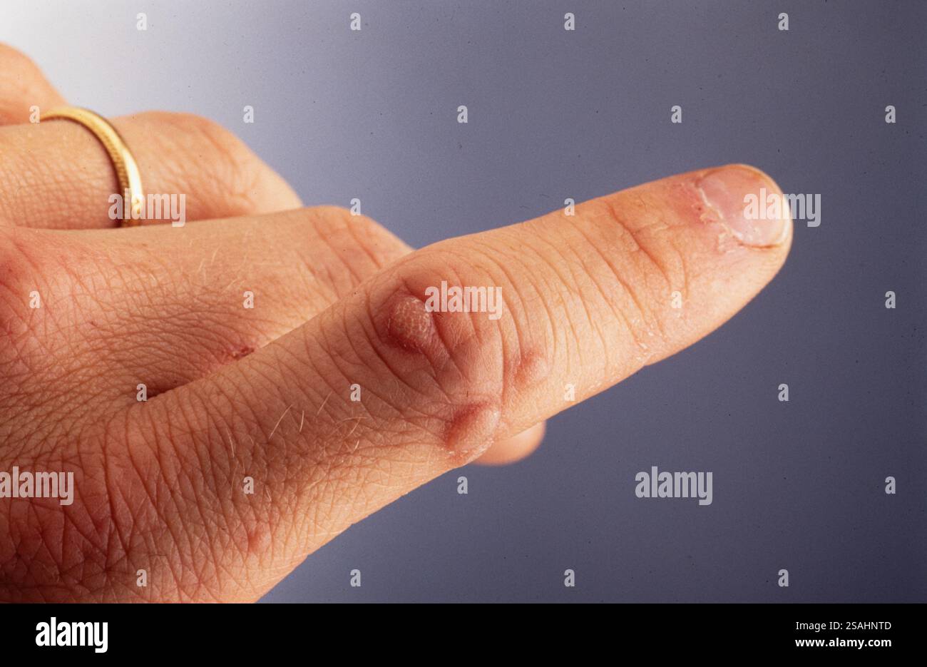 Wart on the index finger of a man's left hand Stock Photo - Alamy