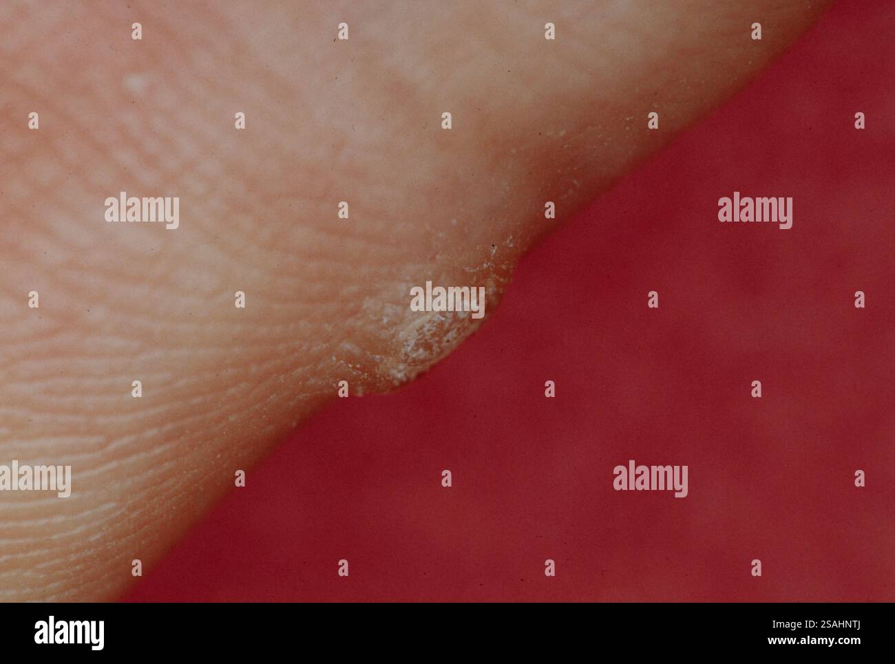 Wart in profile on finger Stock Photo - Alamy