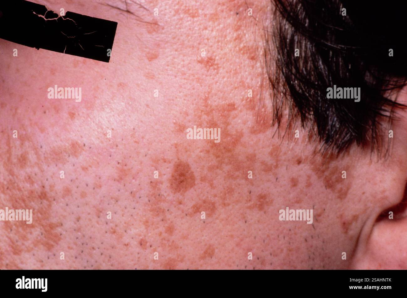 Cheek warts hi-res stock photography and images - Alamy