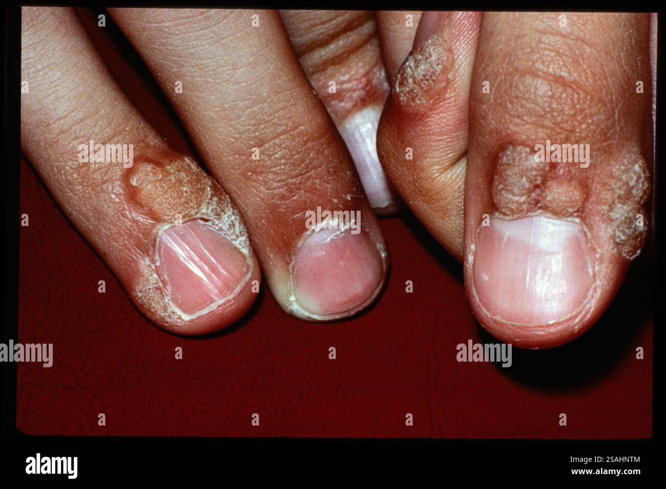 Periungual warts on hands Stock Photo - Alamy