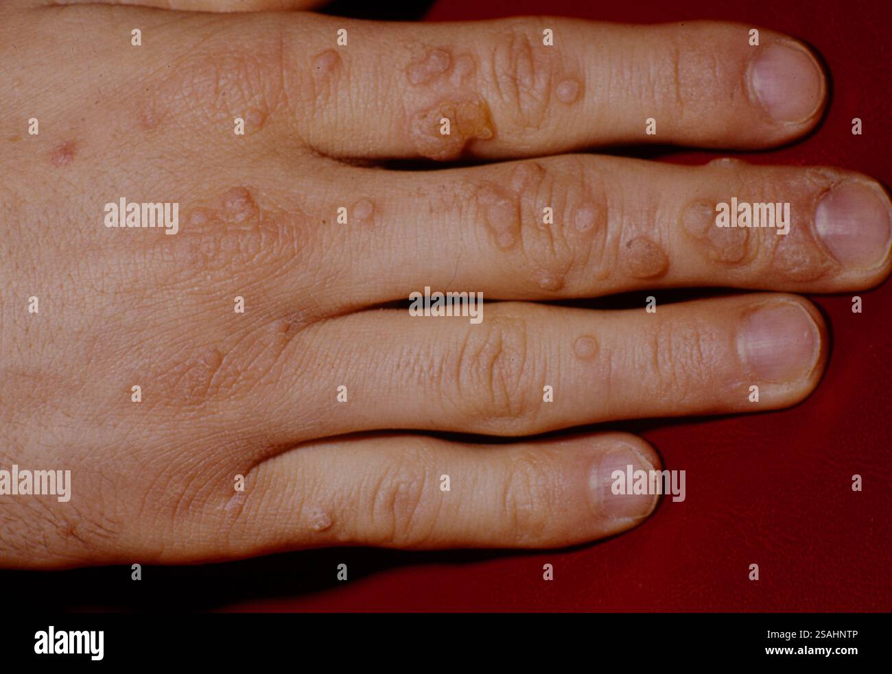 Warts on the back of a man's right hand Stock Photo - Alamy