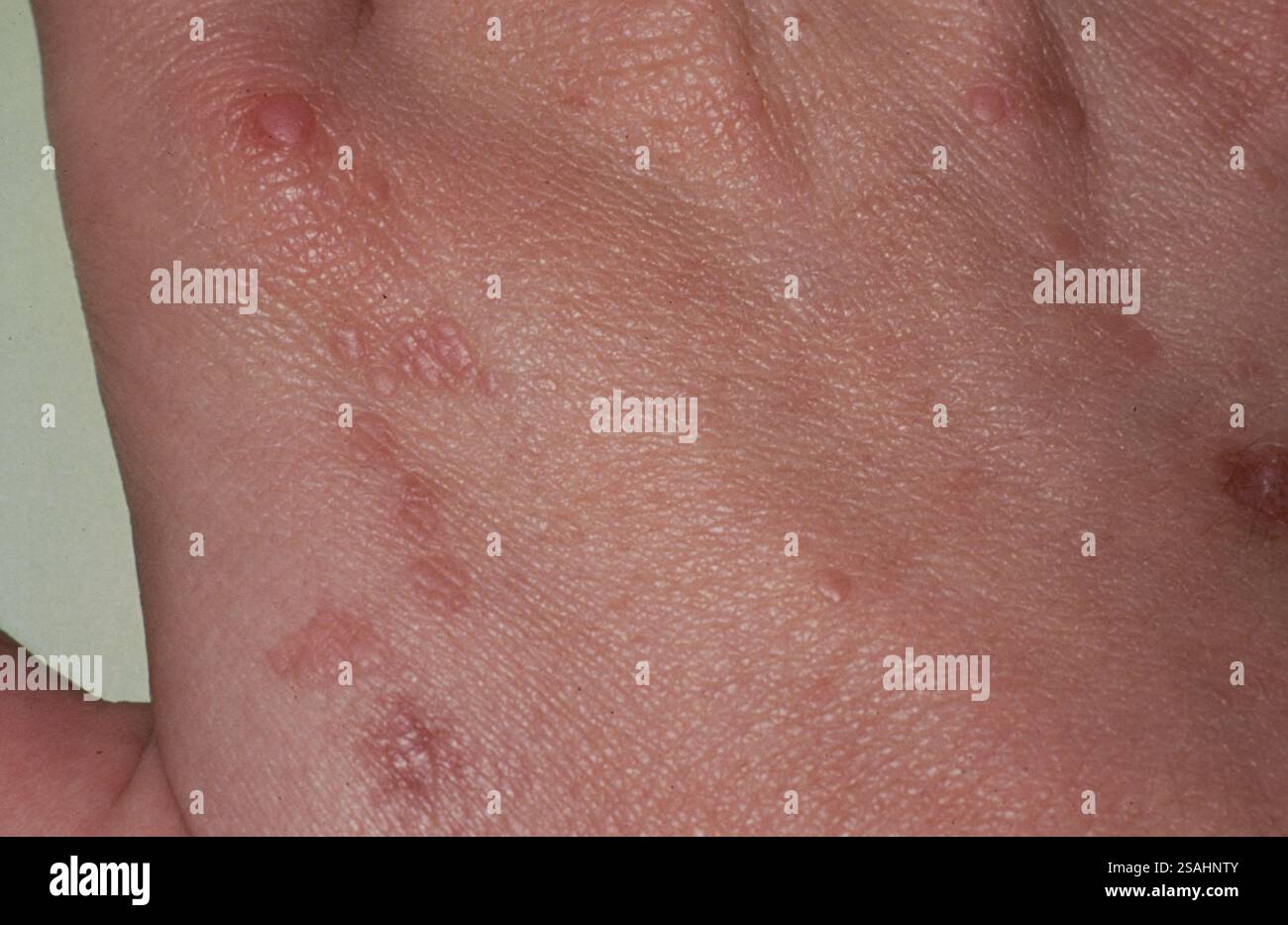 Flat warts on the right hand Stock Photo - Alamy