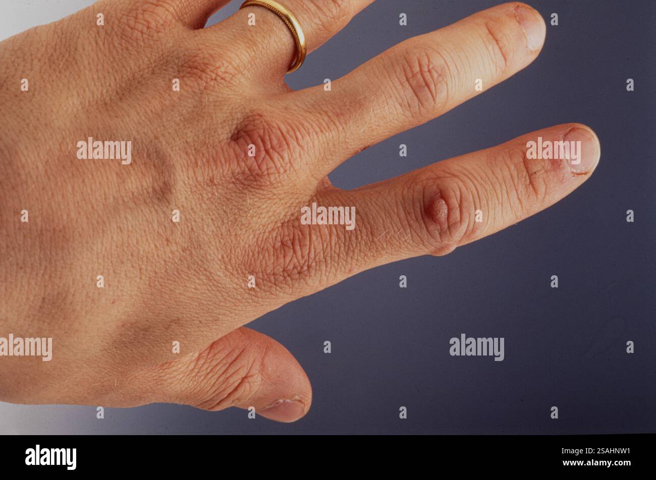 Wart on a man's left index finger Stock Photo - Alamy