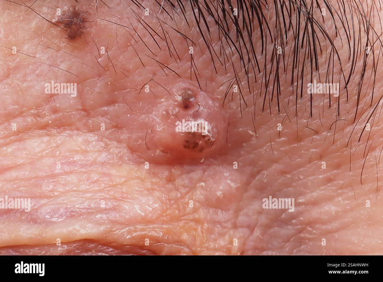 Nodular basal cell carcinoma of the eyelid in a 63-year-old woman Stock ...