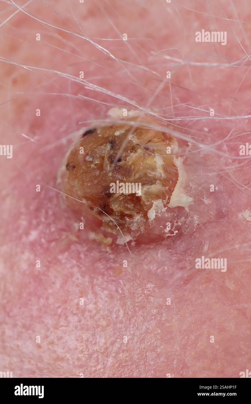 Squamous cell carcinoma of the forehead in a 76-year-old man Stock ...