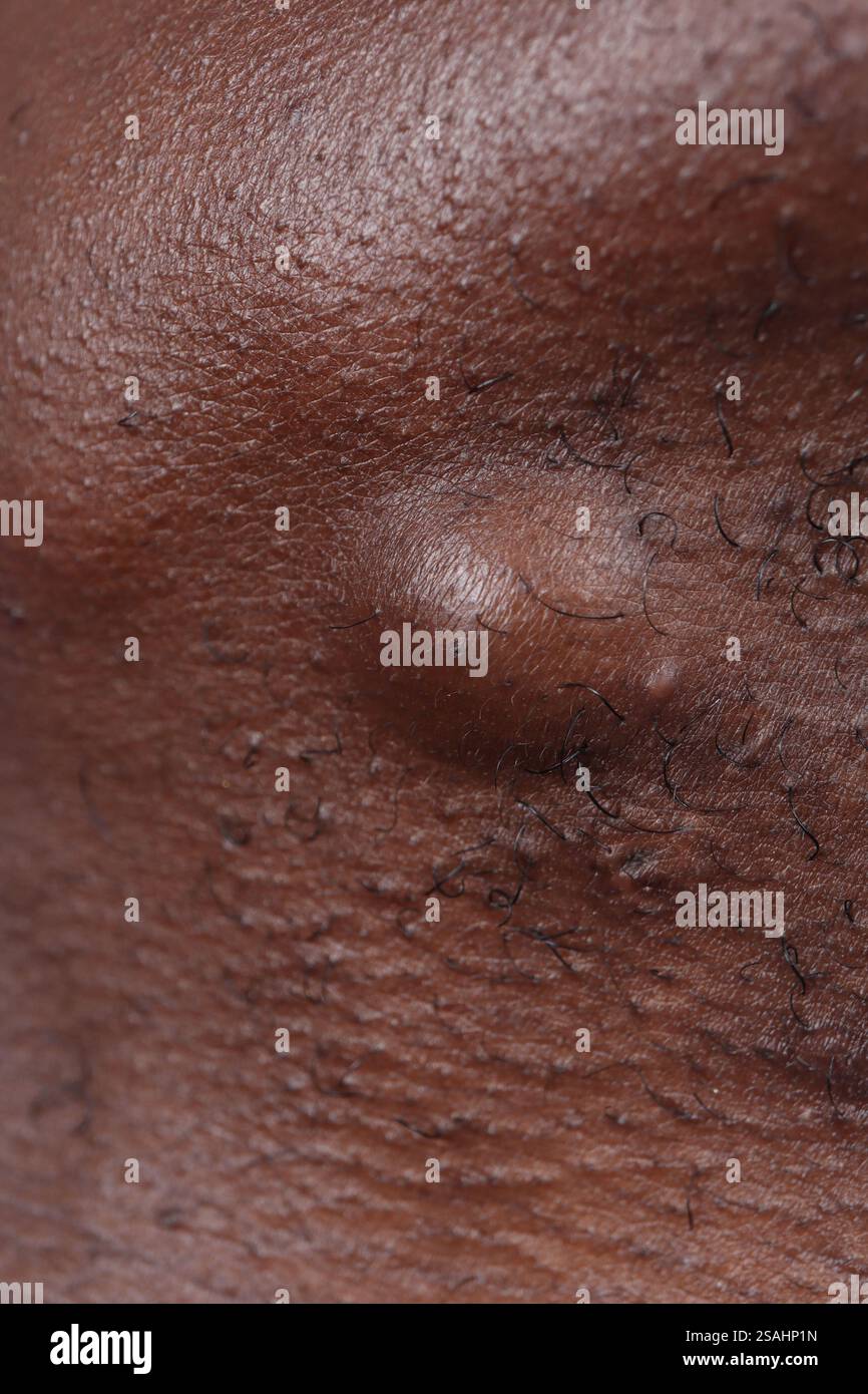 Cervical sebaceous cyst in a 29-year-old man Stock Photo - Alamy