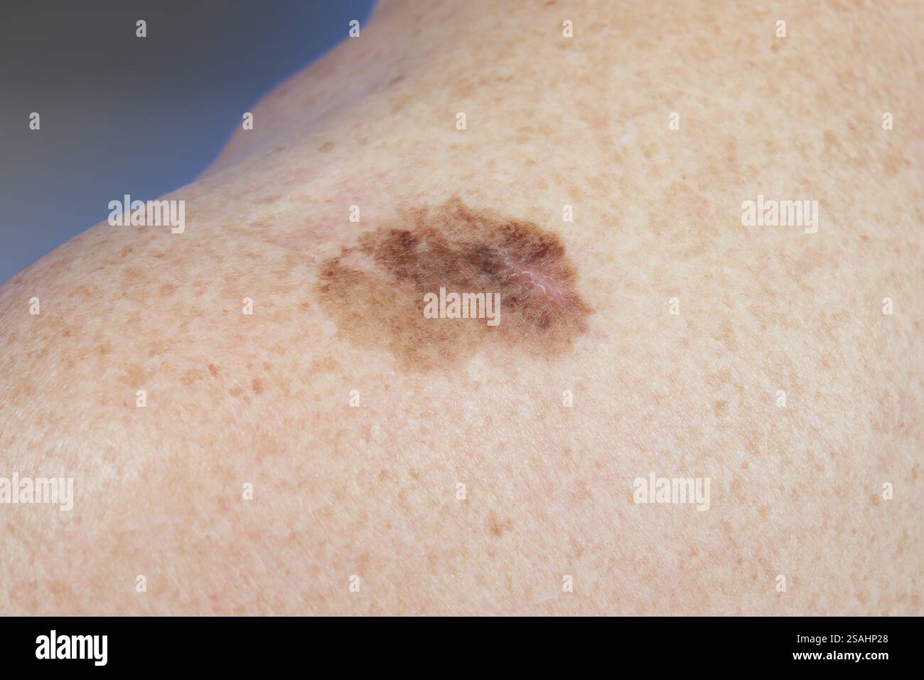 Dubreuilh melanoma of the shoulder in a 77-year-old woman Stock Photo - Alamy