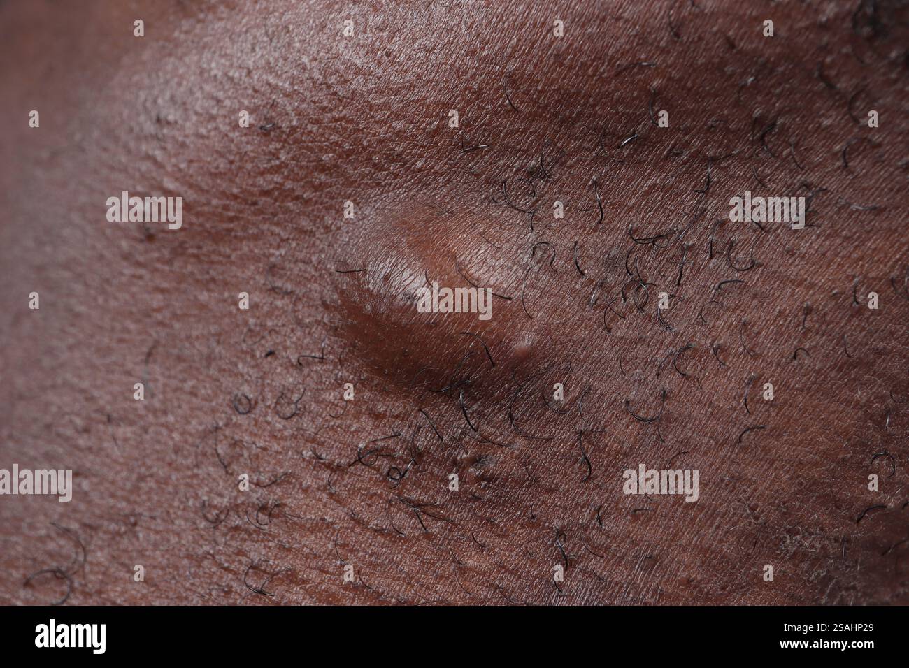 Cervical sebaceous cyst in a 29-year-old man Stock Photo - Alamy