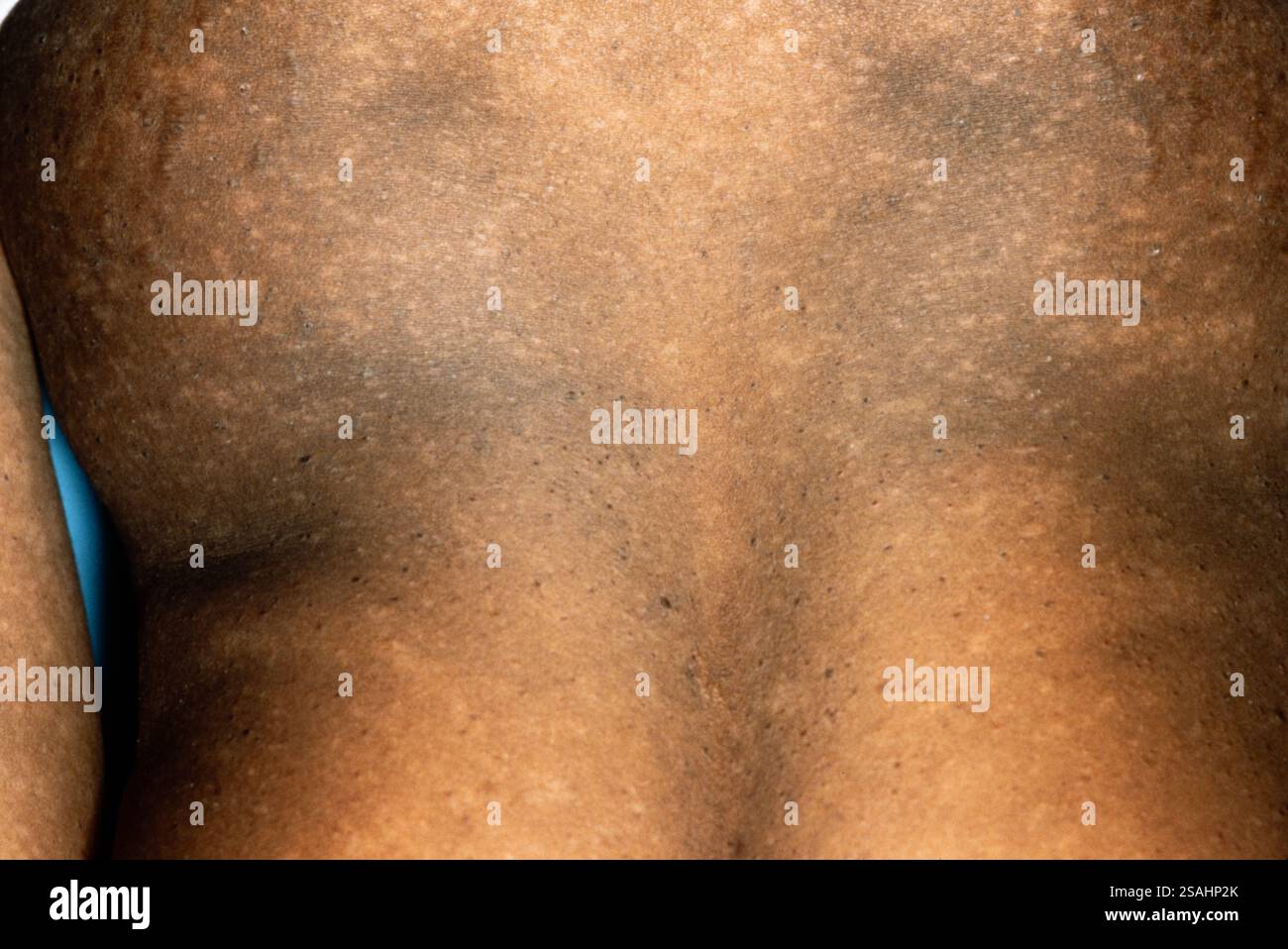 Skin depigmentation or achromia Stock Photo - Alamy