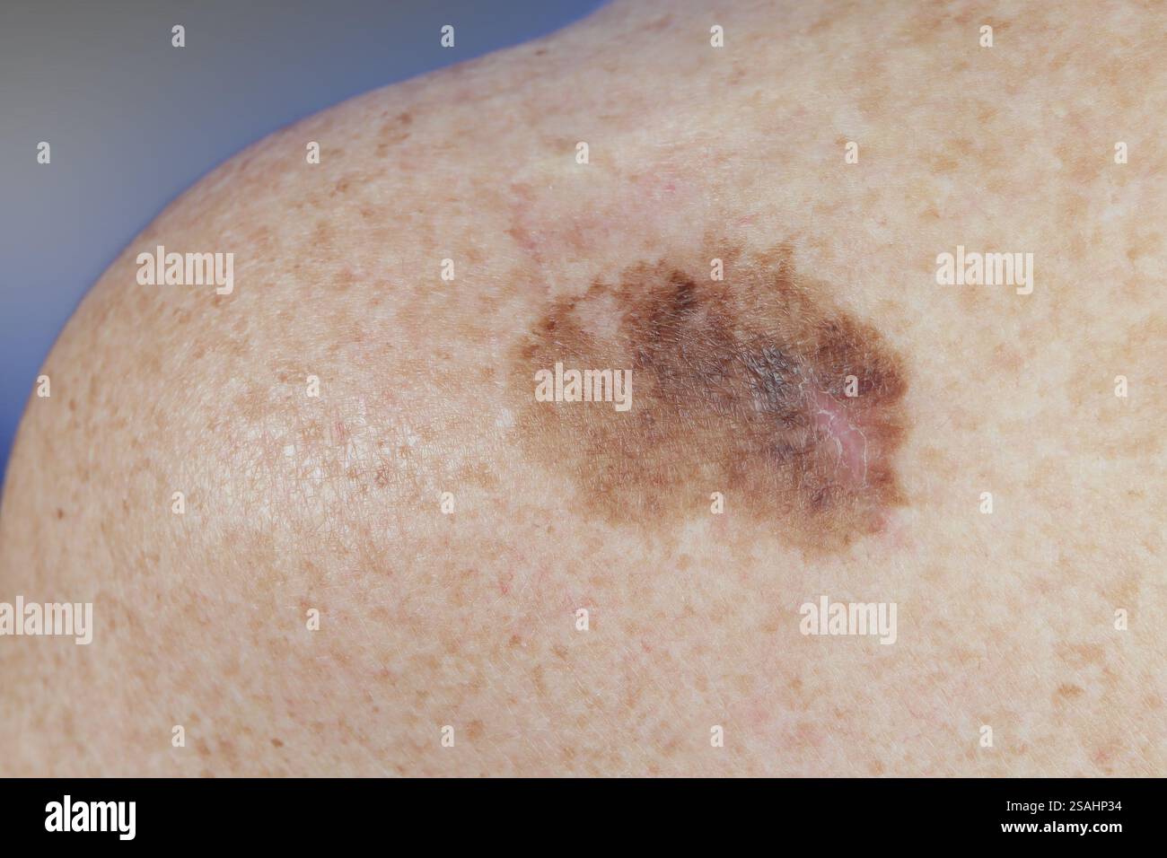 Dubreuilh melanoma of the shoulder in a 77-year-old woman Stock Photo - Alamy
