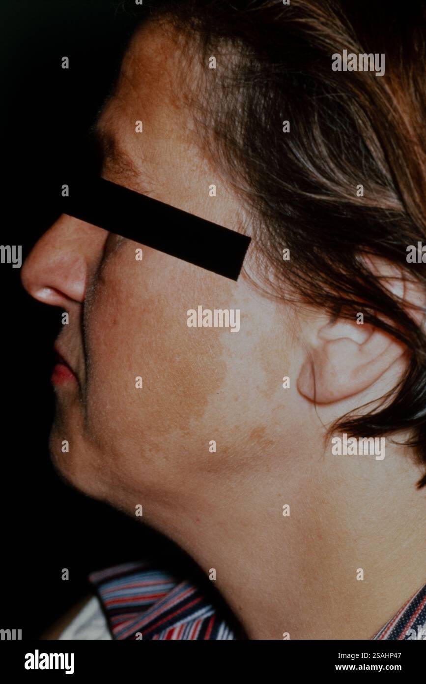 Riehl's melanosis in a 45-year-old woman Stock Photo - Alamy