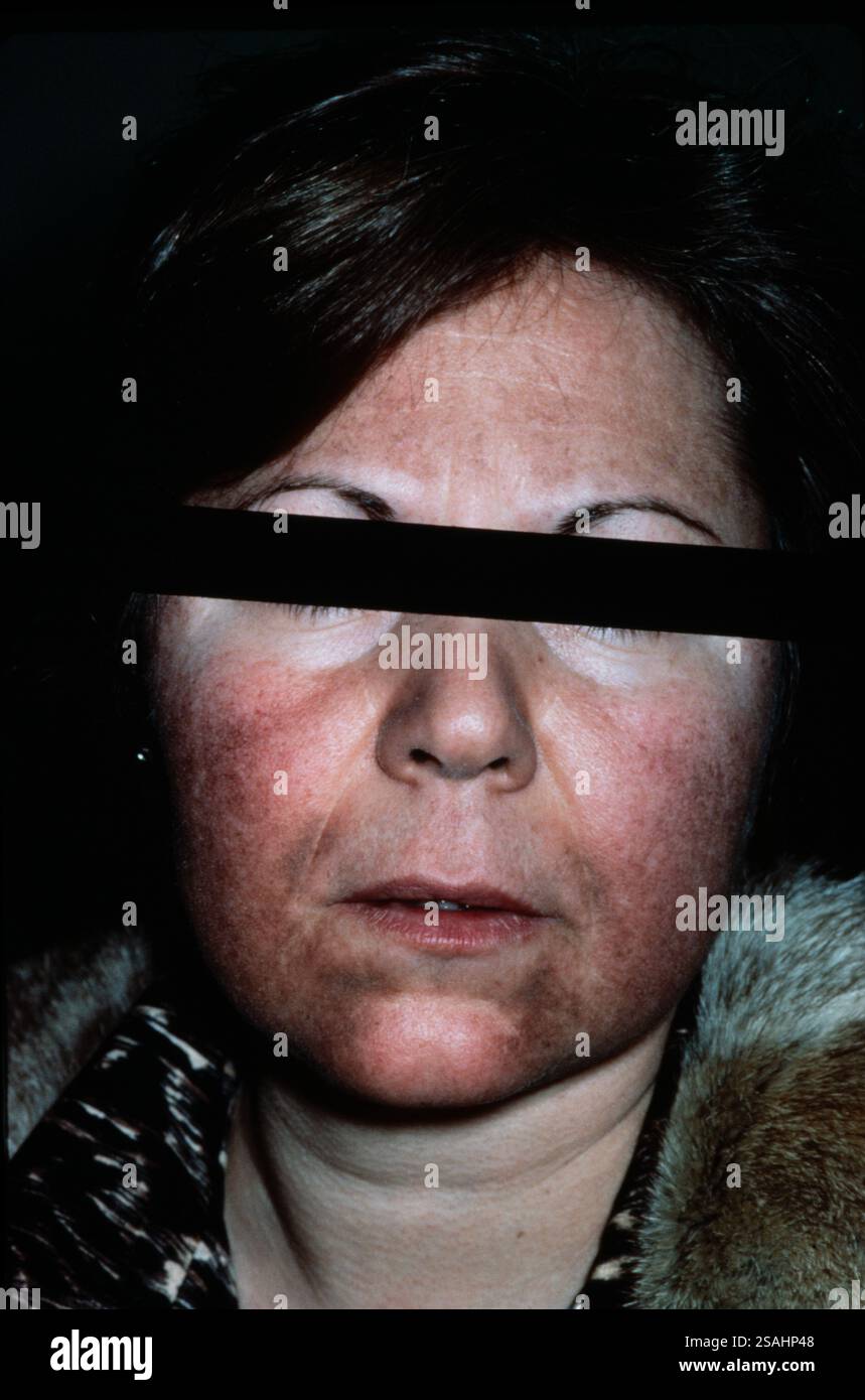 Riehl's melanosis in a 45-year-old woman Stock Photo - Alamy