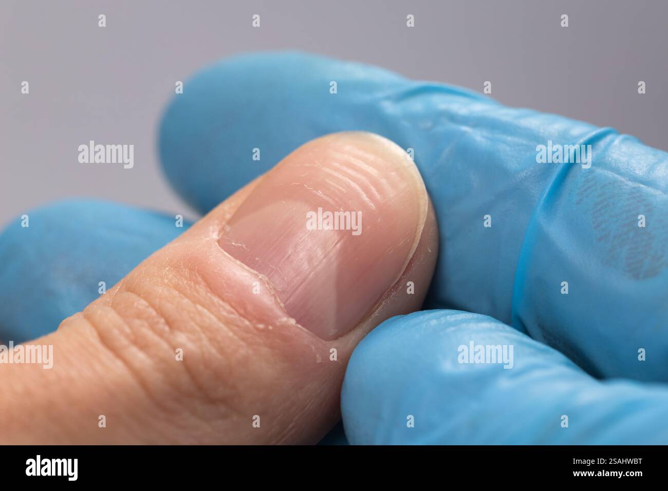 Doctor examining a ridged fingernails with vertical and horizontal ...