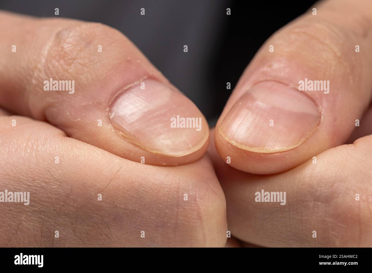 Ridged fingernail of a thumb finger of a man with horizontal ridges on ...