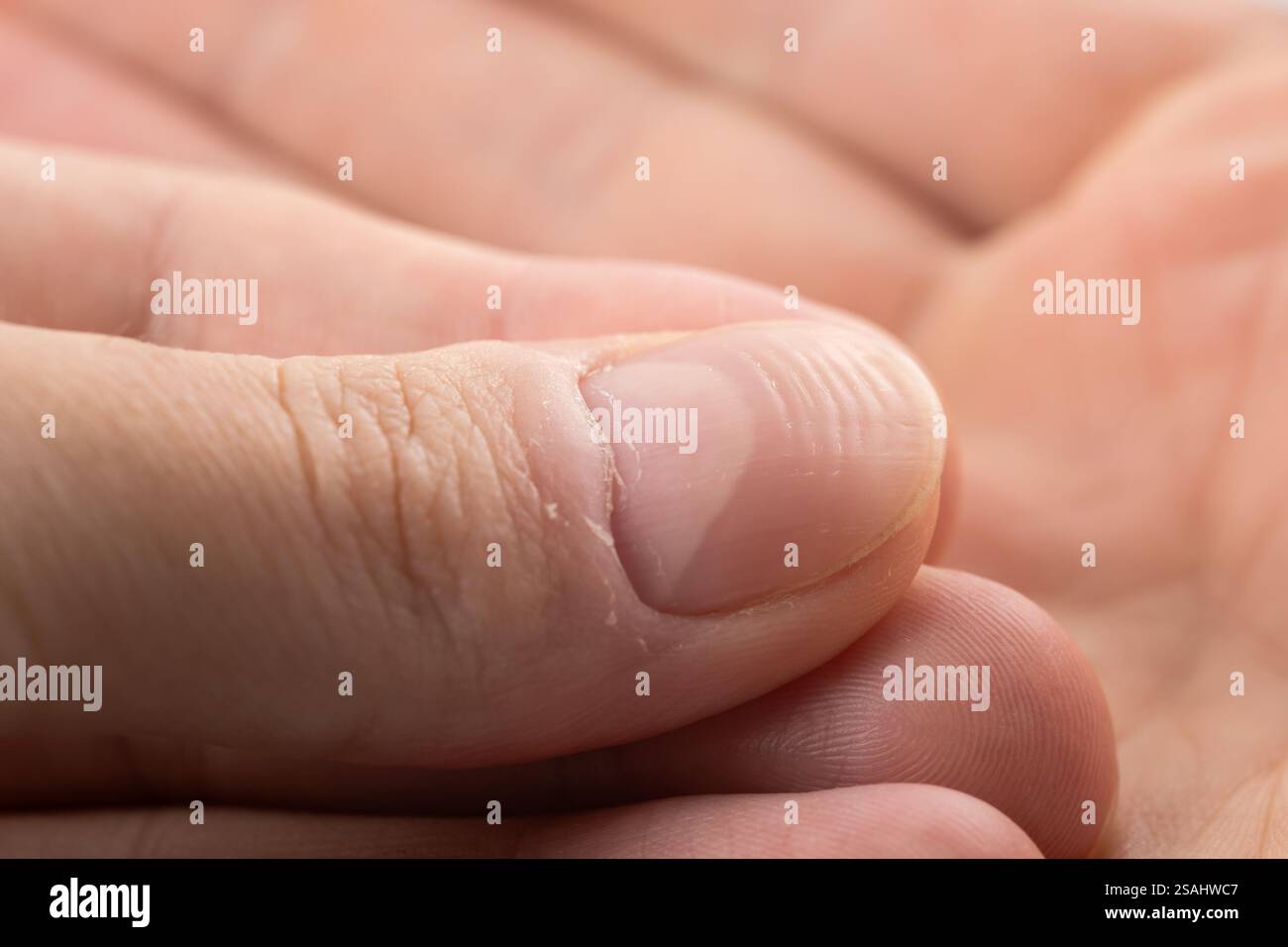 Ridged fingernails with vertical and horizontal ridges. Nails problems ...