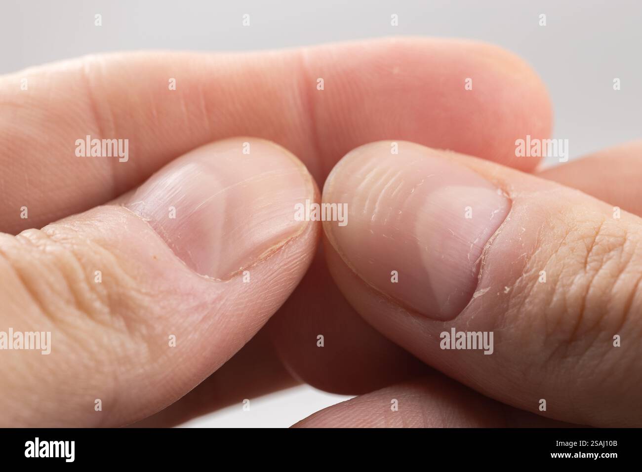 Ridged fingernails with vertical and horizontal ridges. Nails problems ...