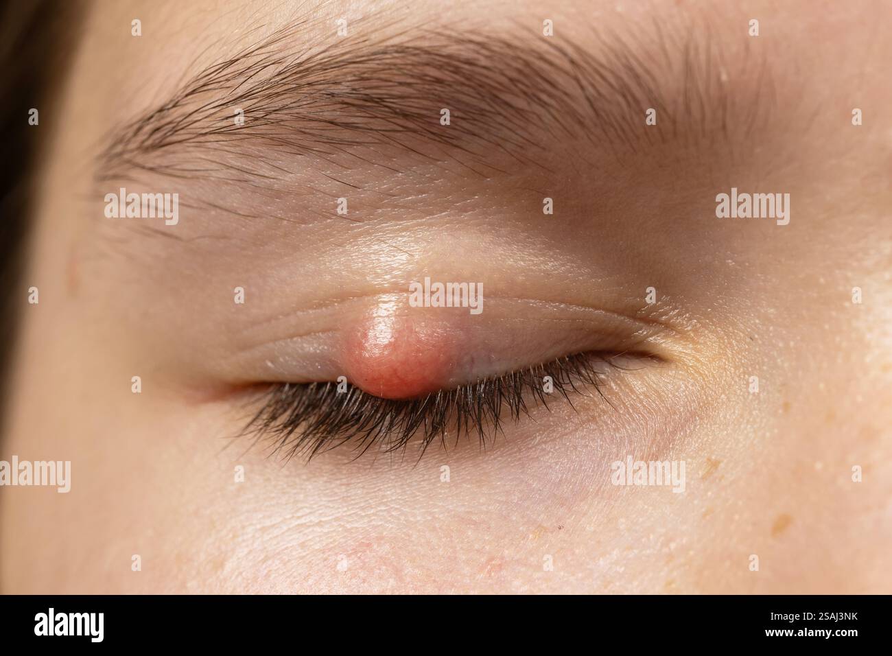 Chalazion on the eyelid of girl macro. Demodicosis mite diseas, demodex ...