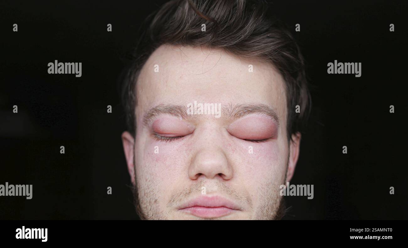 A person with both eyes closed, showing a calm expression in moderate ...