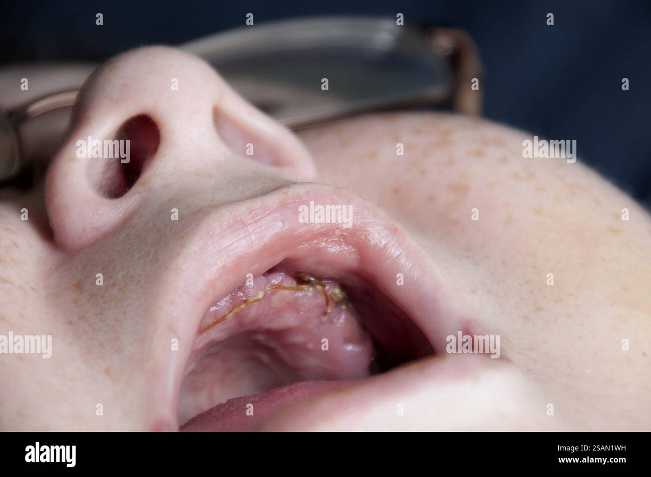 Woman who has had oral surgery removing all her teeth Stock Photo - Alamy