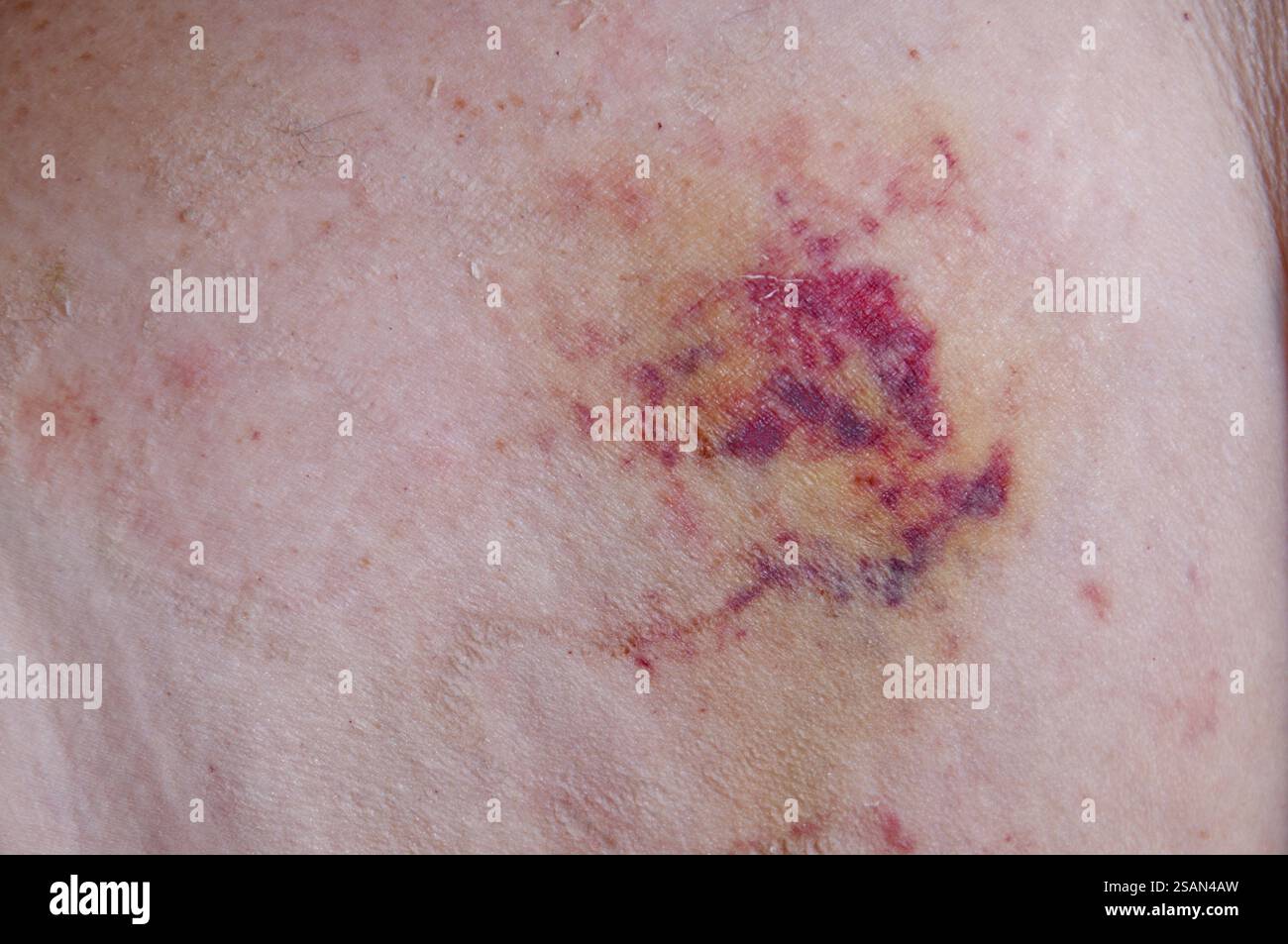 Black and blue bruise at a medical IV site Stock Photo - Alamy