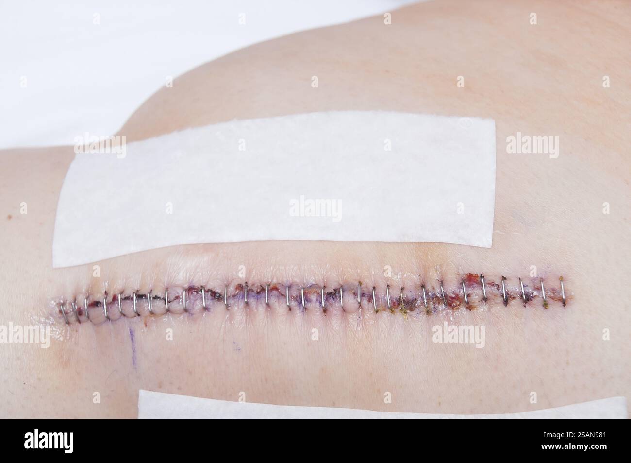 Staples in a patients knee after a total knee replacement Stock Photo ...