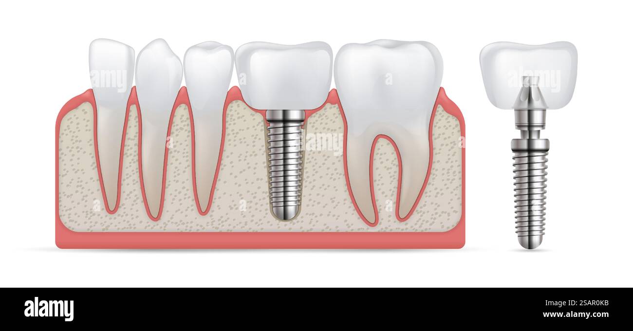 Dental implant. Teeth care surgery and crown fixture. Tooth replacement ...