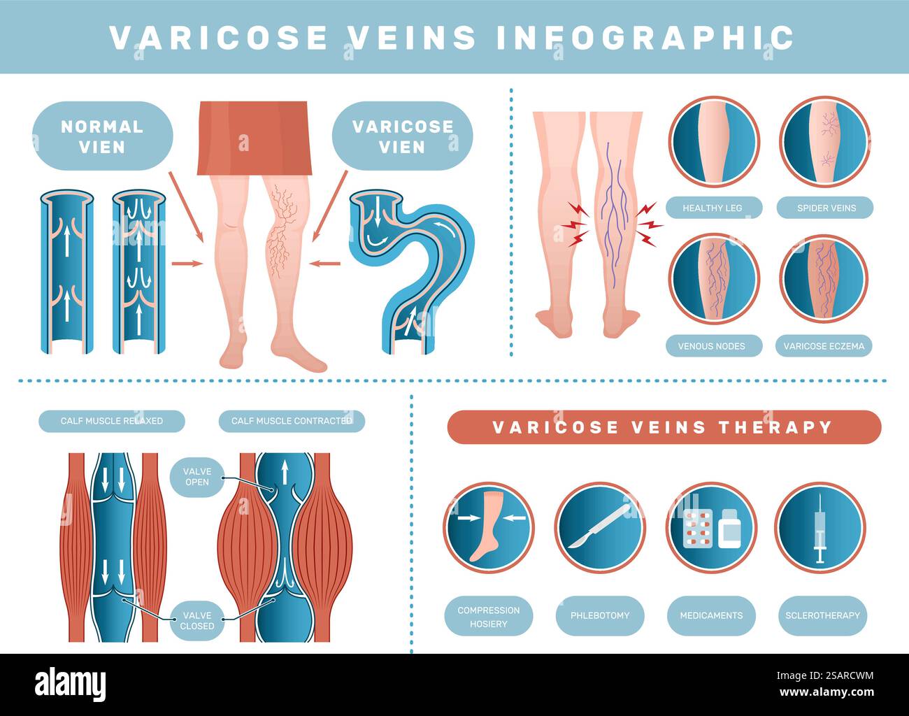 Varicose infographic. Venous disease medical health problems with human ...