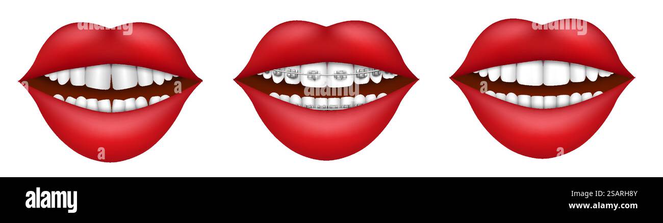 Female mouth with dental braces, crooked and straight teeth vector ...