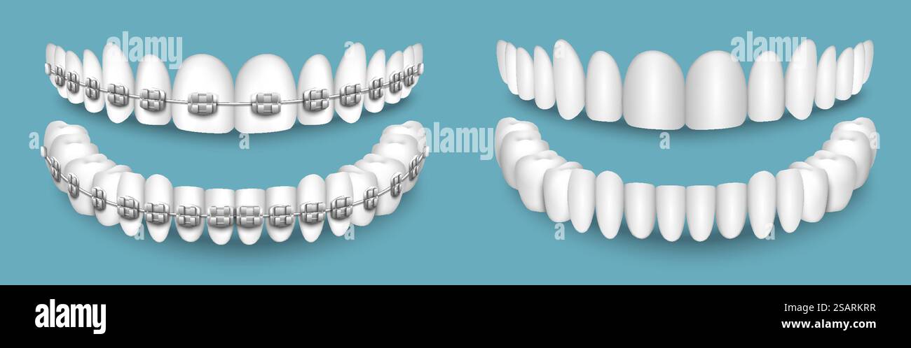 Teeth with or without braces, before and after alignment vector ...