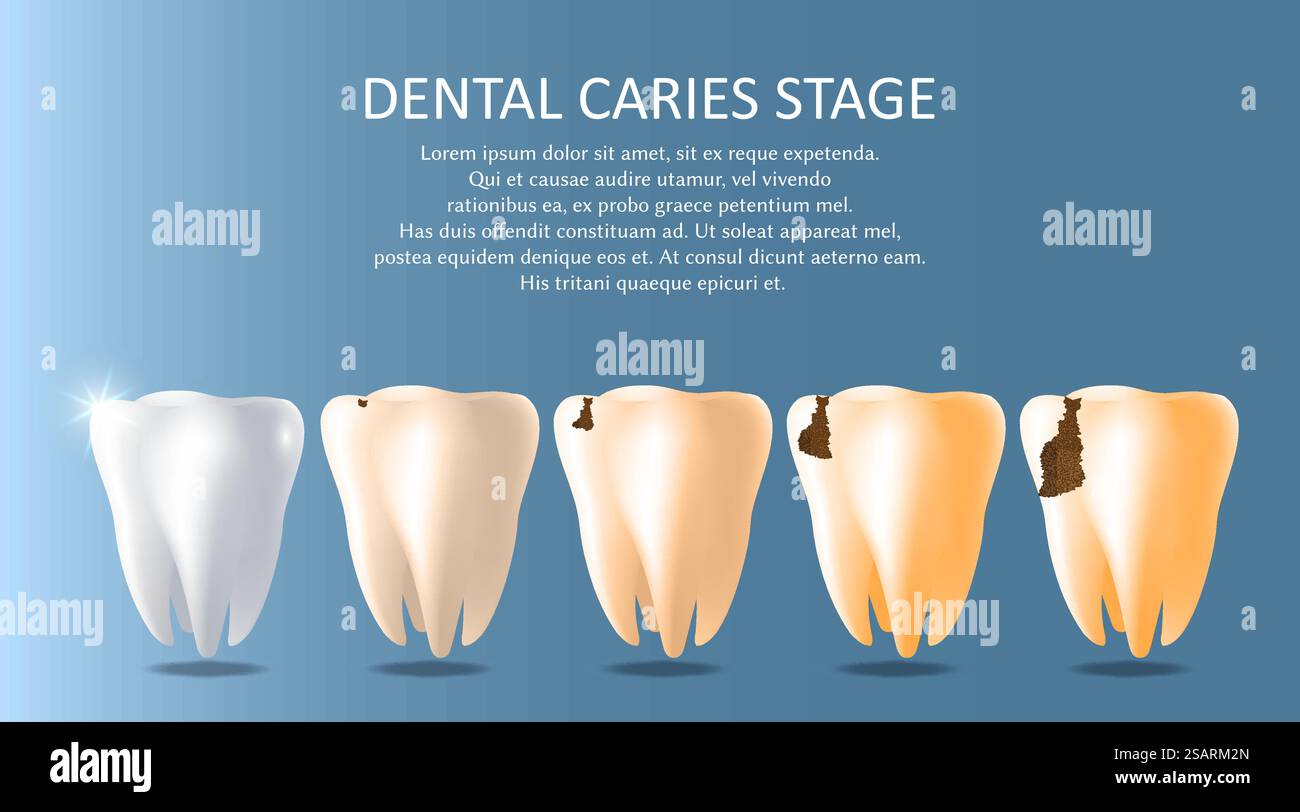 Dental caries stages vector medical poster banner template. White healthy tooth and bad teeth ...
