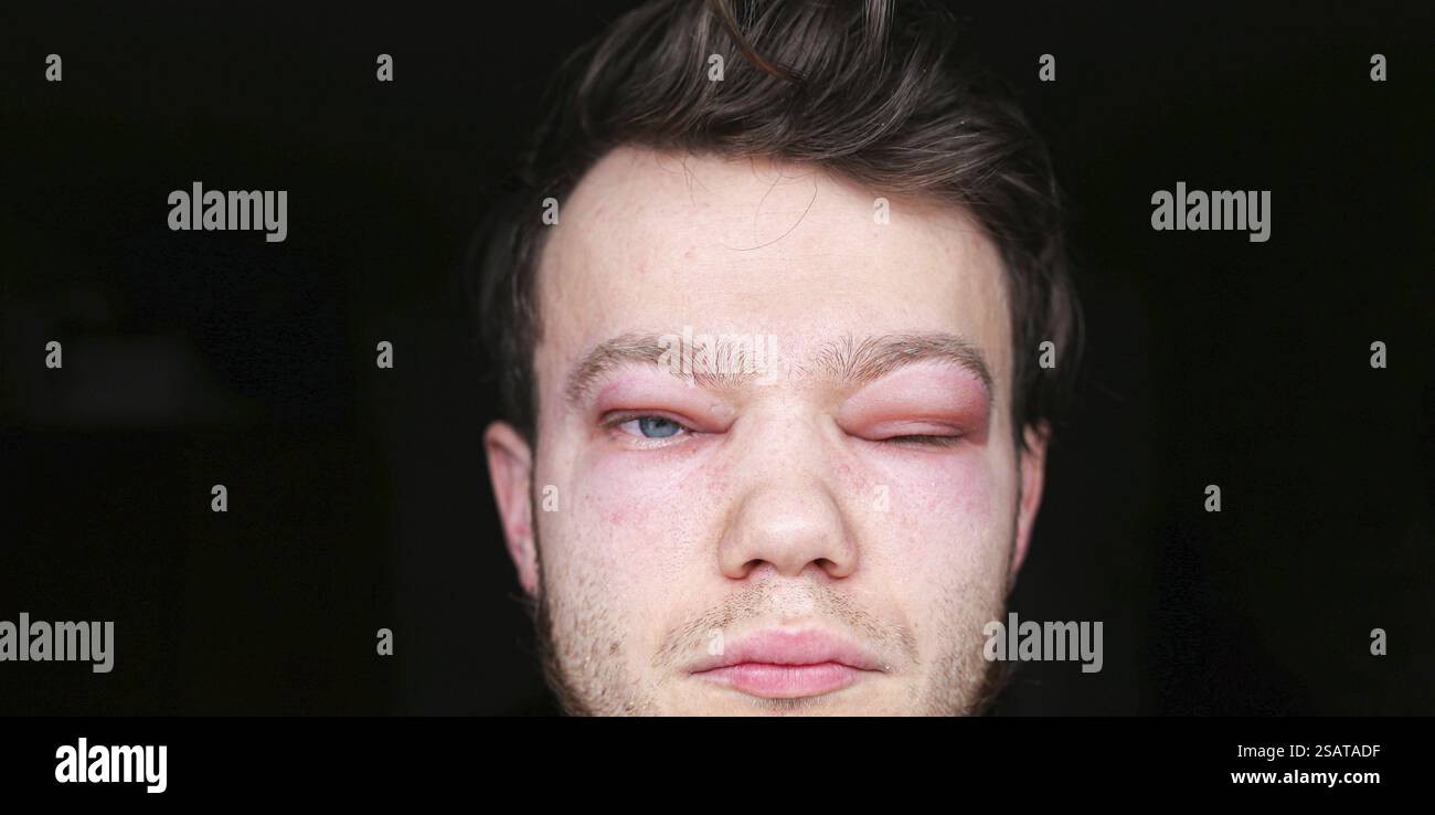 A person with a swollen eye partially closed in moderate lighting ...