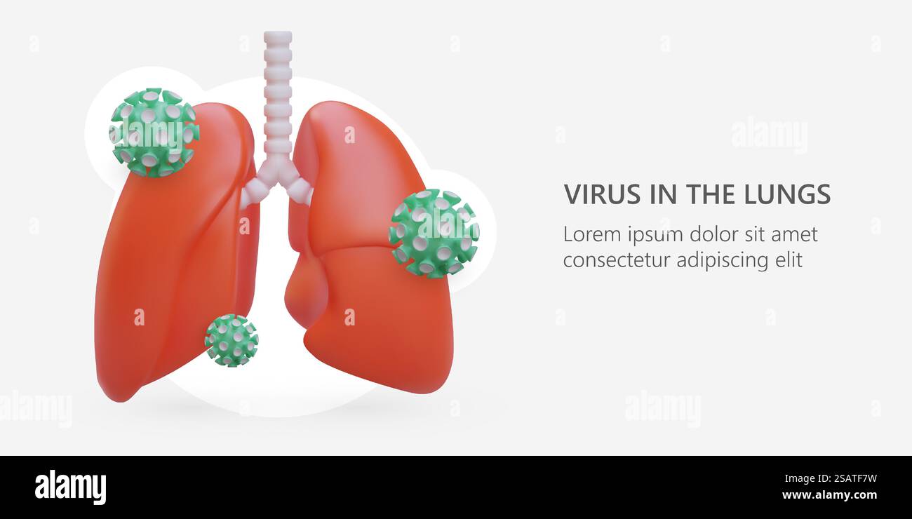 Virus in lungs. Realistic color illustration. Corona virus attack ...