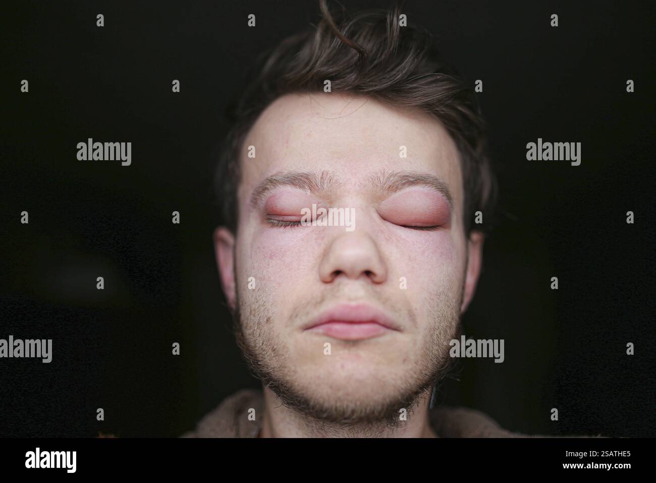 A man with closed swollen eyes, conveying rest and relaxation in a ...