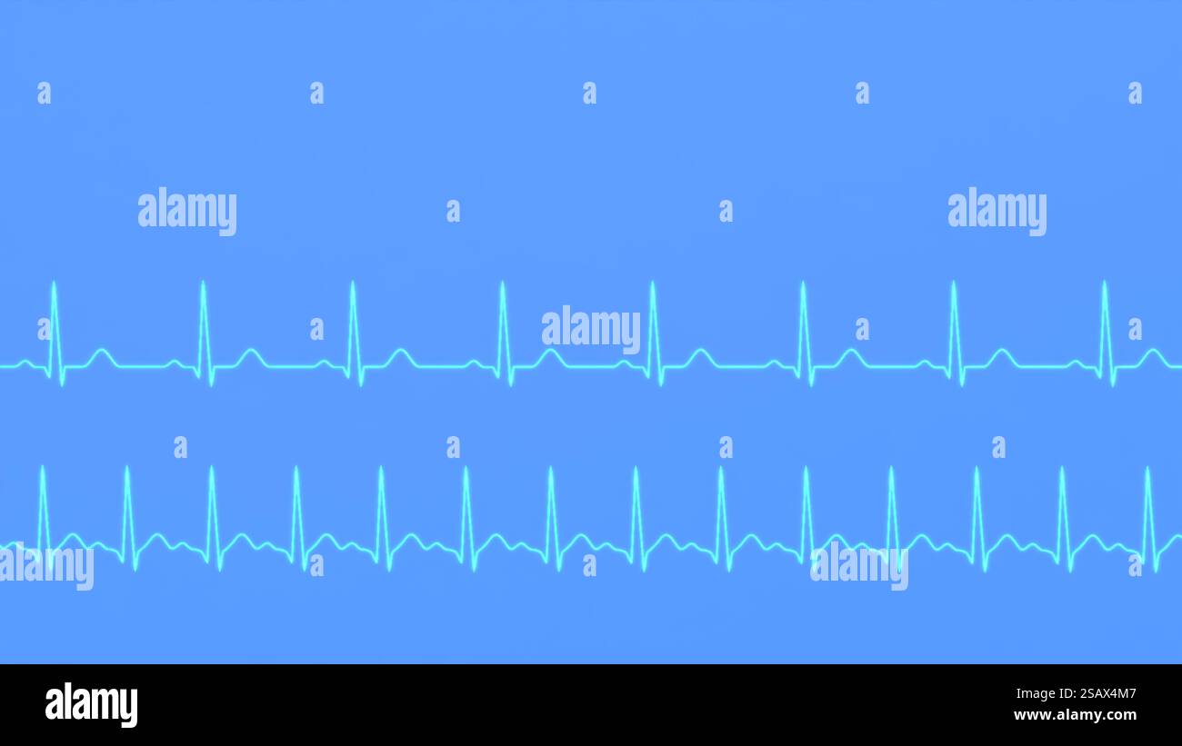Comparison of ECG of normal heart rhythm and tachycardia Stock Photo ...