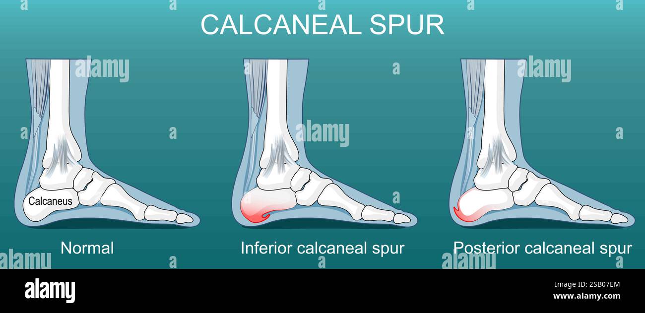 Calcaneal spur. Osteophytes on the posterior and inferior aspects of ...