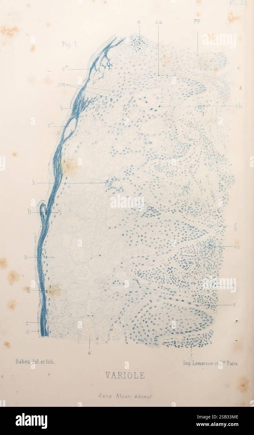 Variolas characteristics hi-res stock photography and images - Alamy