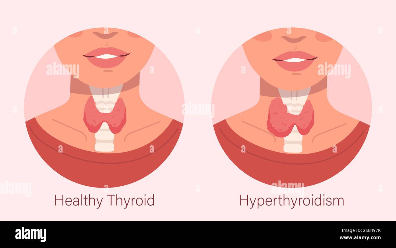 Healthy vs. Hyperthyroidism. Vector illustration Stock Vector Image ...