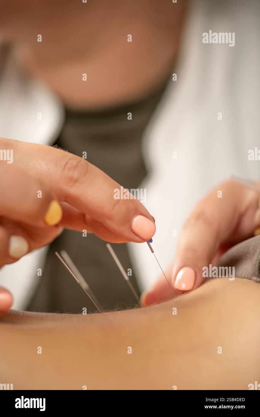 Acupuncture for lower back pain Stock Photo - Alamy