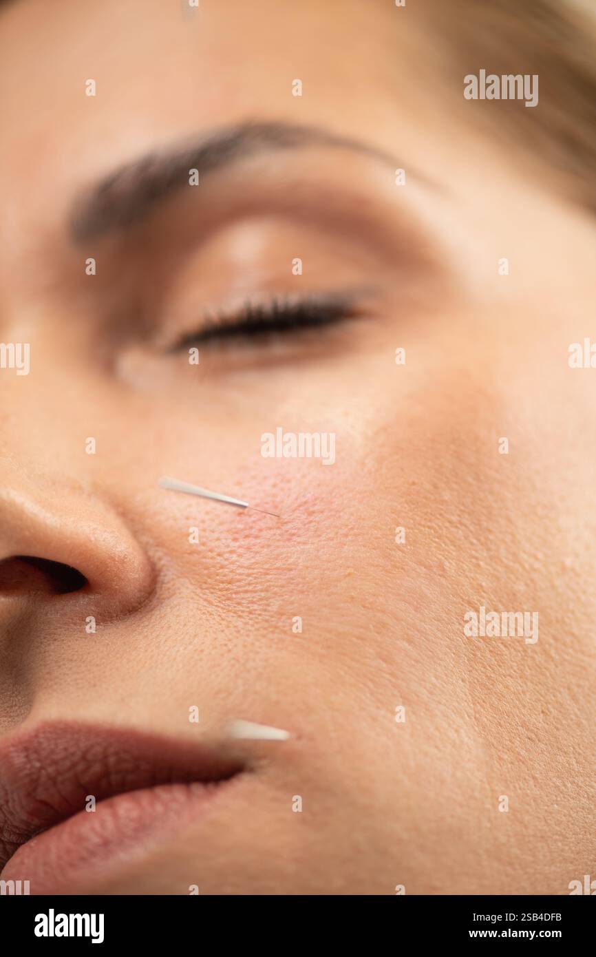 Acupuncture treatment for facial paralysis Stock Photo - Alamy