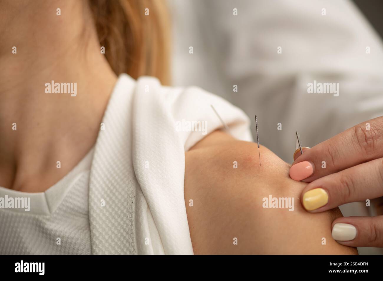 Acupuncture treatment for shoulder pain and rotator cuff injuries Stock ...