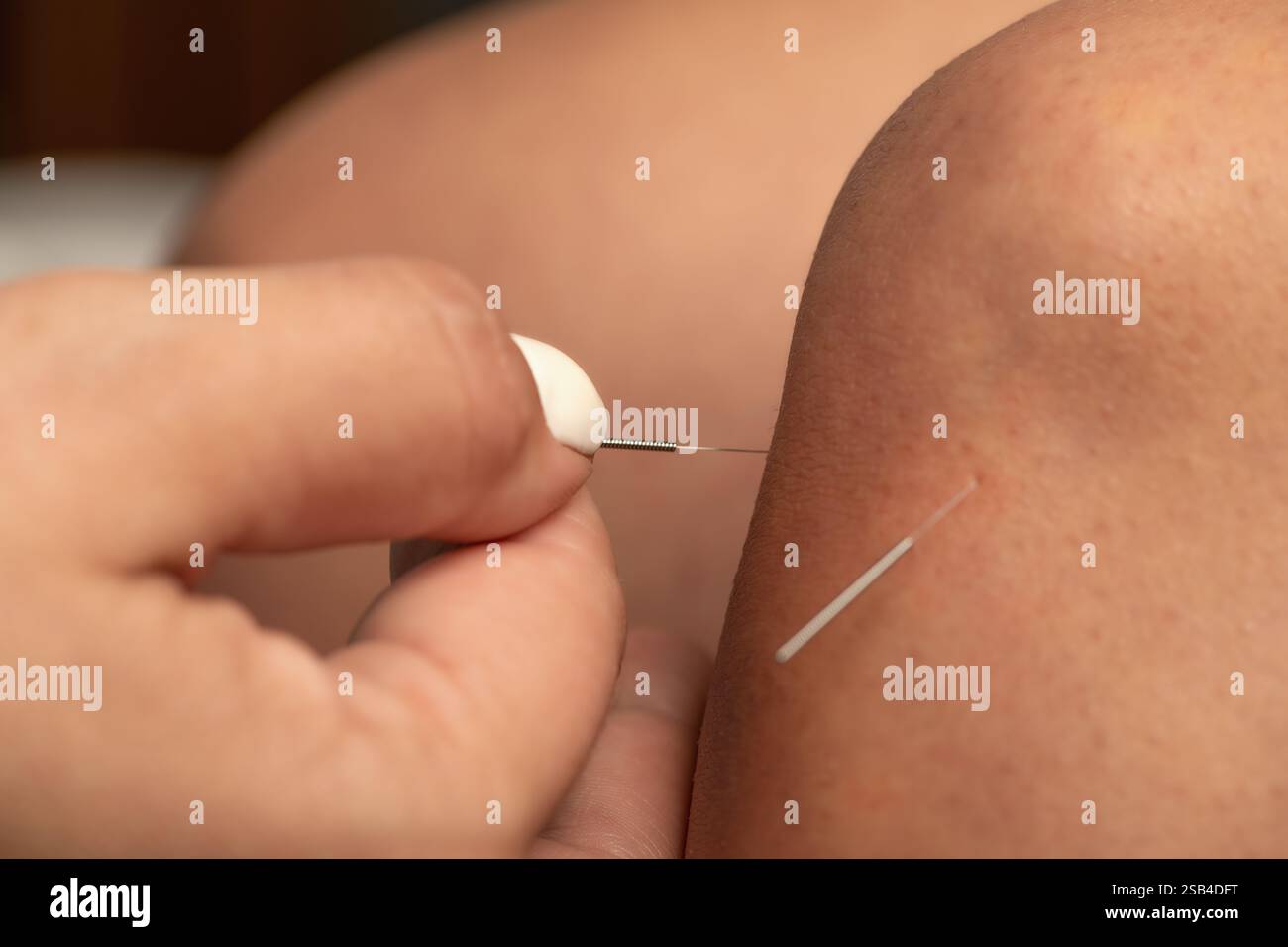 Acupuncture for relieving osteoarthritis knee pain Stock Photo - Alamy